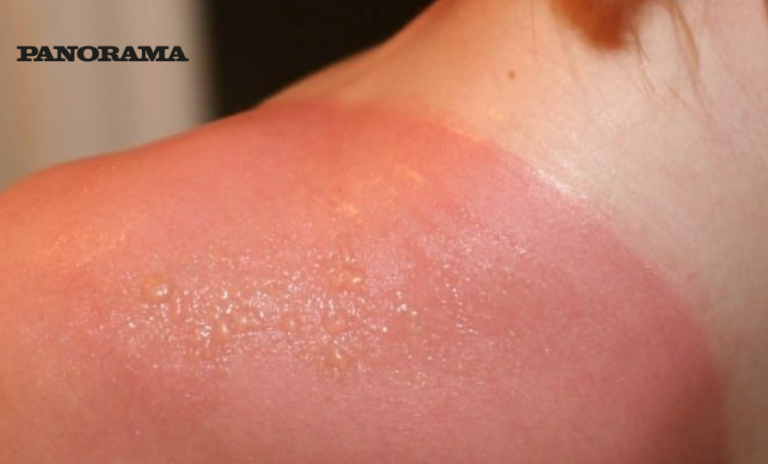 Rimedi naturali contro l'eritema solare - Panorama - Istituto ...