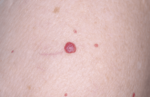 Angioma cutaneo: classificazione generale e strutturale - Istituto ...